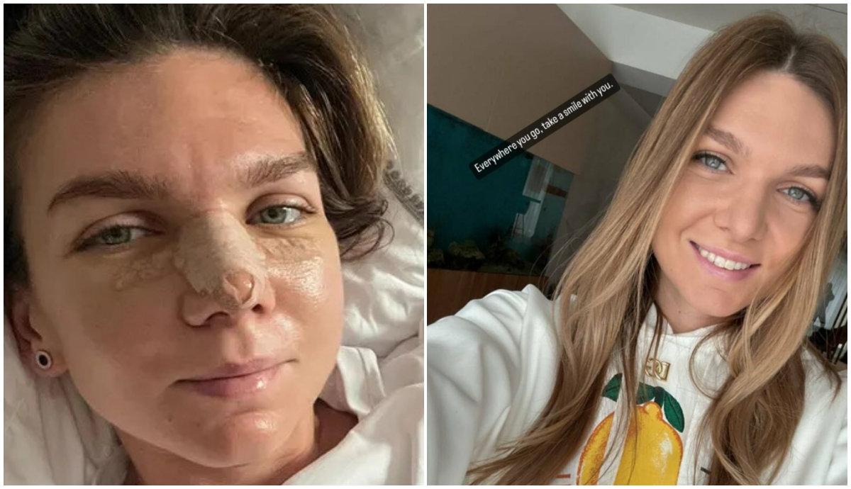 Doctorul care i-a făcut operația estetică Simonei Halep explică!